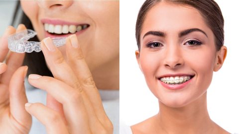 Pros and Cons of Invisible Braces